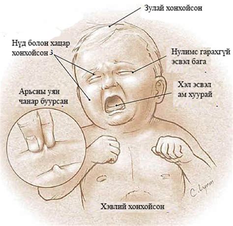 ЭХЭМҮТ ийн их эмч Б Номин Суулгалт өвчний үед вирусийн эсрэг эмийн