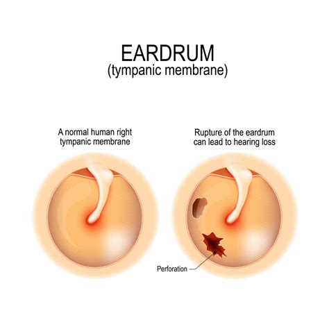 What Does An Unhealthy Eardrum Look Like