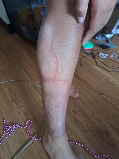 Very Itchy Rash On Leg Ive Had For 3 Years Spreading Significantly