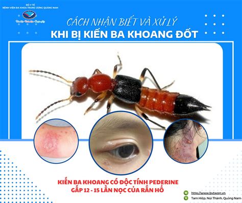 Cách Nhận Biết Và Xử Trí Khi Bị Kiến Ba Khoang đốt