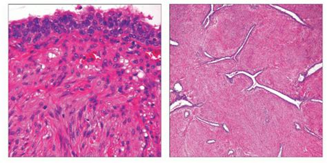 Hyperplasia Of Mesonephric Remnants Basicmedical Key