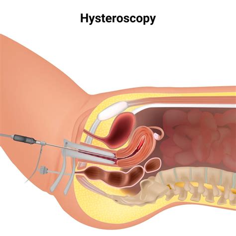 Hysteroscopy Procedure Midtown Nyc And Rego Park Queens Diagnostic