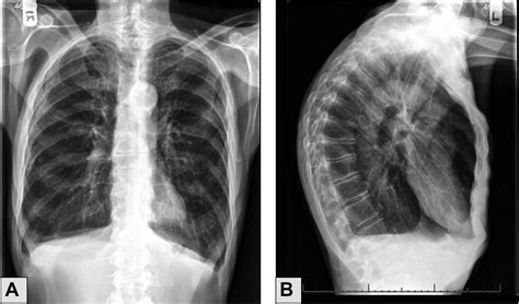 Lung Imaging In Copd Part 1 Chest