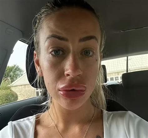 20대 여성 입술 풍선처럼 부풀어 알레르기 때문