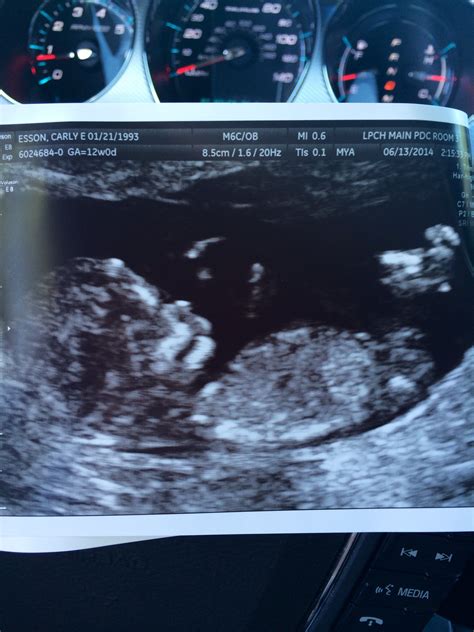 Nt Scan Gender The Bump