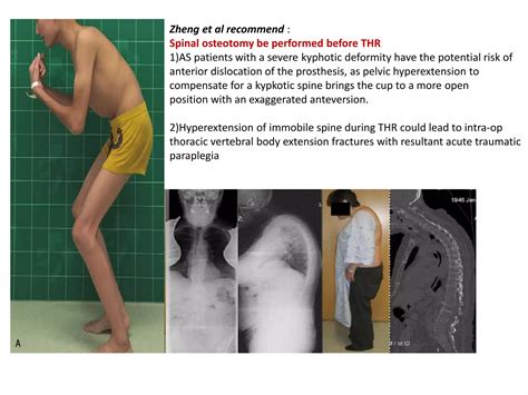 Tips And Tricks Of Total Hip Arthroplasty In Ankylosing Spondylitis Ppt