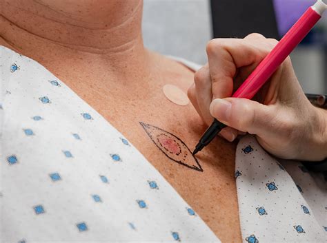 Skin Cancer Surgery