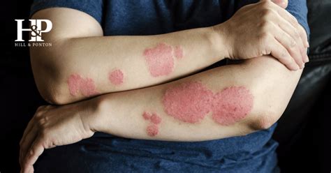 Gulf War Skin Conditions Hill And Ponton Pa