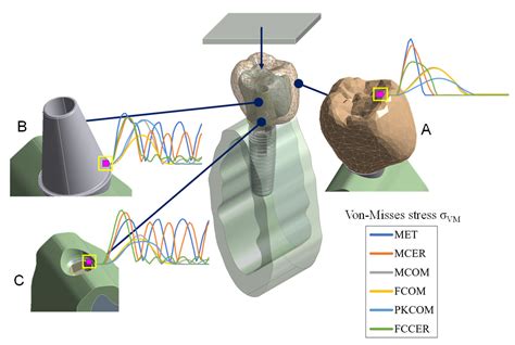 A 3d Finite Element Analysis Model Of Single Implant Supported Prosthesis Under Dynamic Impact