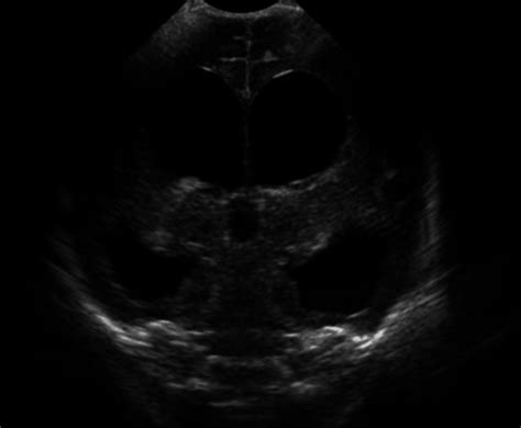 Usefulness Of Neurosonogram In Critical Ill Neonates Pmc