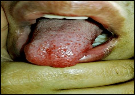 Angular Stomatitis
