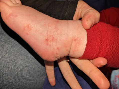 Scabies On Feet Just Wont Go Rscabies