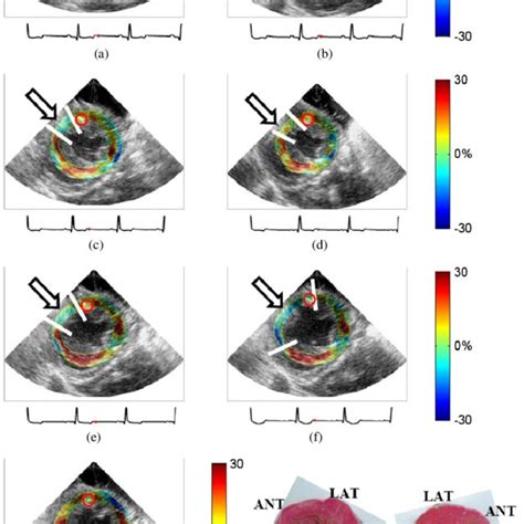 Left Anterior View Of A Schematic Heart Sub Endocardial Download