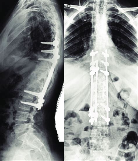 Postoperative Lateral Left And Anteroposterior Right Radiographs Of