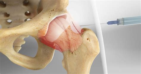 Opinions Of Orthopedic Surgeon Mastering Hip Joint Injection Techniques Освоєння техніки ін