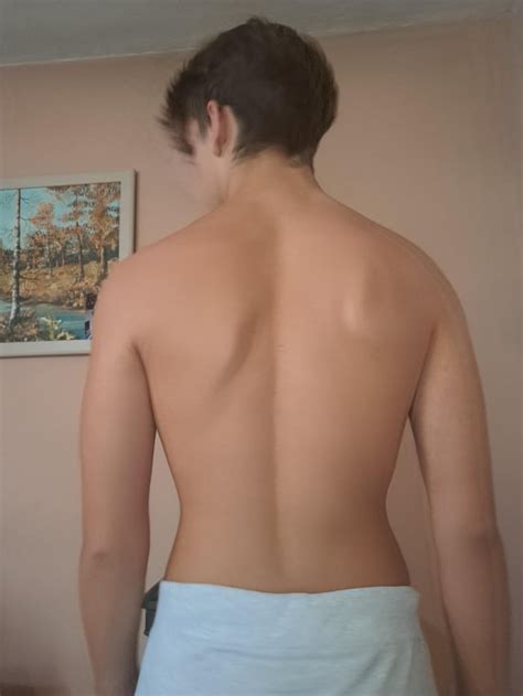 Winged Scapula R Posturetipsguide