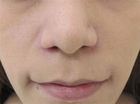 【症例写真・ダウンタイム】お鼻の穴を正面から目立たないように Taクリニック｜美容整形･美容外科｜新宿･銀座･横浜･大阪･福岡･川越･高崎