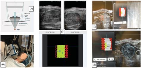 Hifu Procedure A Diagram Of The Active Head Focalization Of Download Scientific Diagram