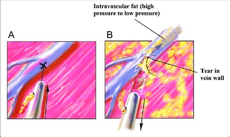 Illustration Of Injury To A Gluteal Vein Wall By Fat Grafting Cannula