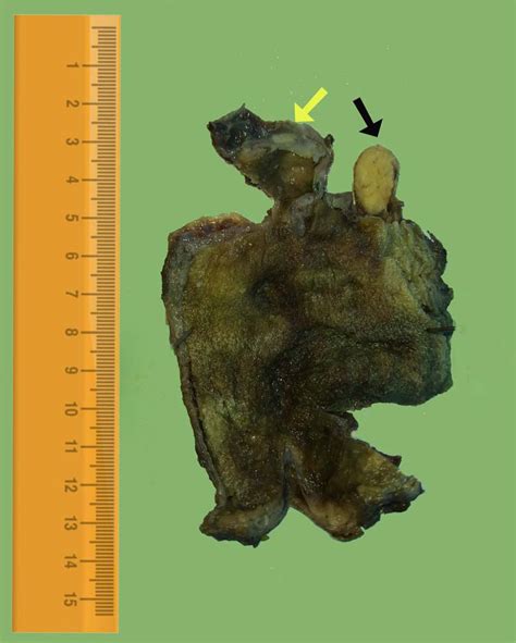 Gross Image Of The Excised Gallbladder Cut Section Revealed A Download Scientific Diagram