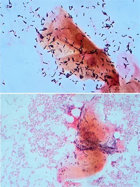 Gardnerella Vaginalis Habitat Morphology Genome Treatment