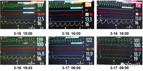 Ecmo E Cpr