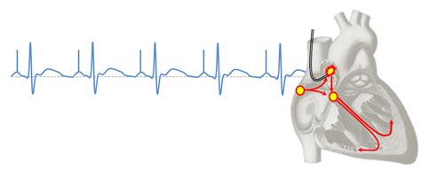 Single And Dual Chamber Pacing Modes Deranged Physiology