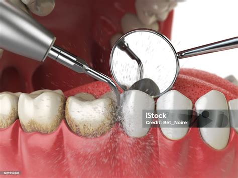 전문적인 치아 청소입니다 초음파 이빨 청소 기계는 인간의 치아에서 치과 미적분학을 삭제 합니다 치아 건강에 대한 스톡 사진 및 기타 이미지 Istock