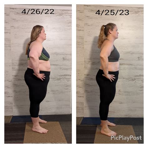 1 Year Post Op Rgastricbypass
