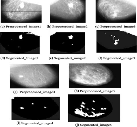 Adaptive Resource Allocation Neural Network Based Mammogram Image