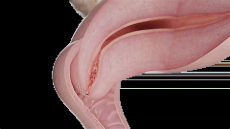 Bartholinitis Causas Síntomas Signos Diagnóstico Y Tratamiento De