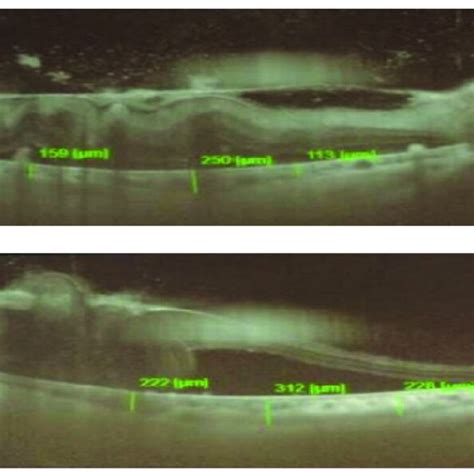 Macular Oct After Two Weeks Follow Up Showing Thick Erm Covering