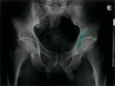 Osteosarcoma X Ray