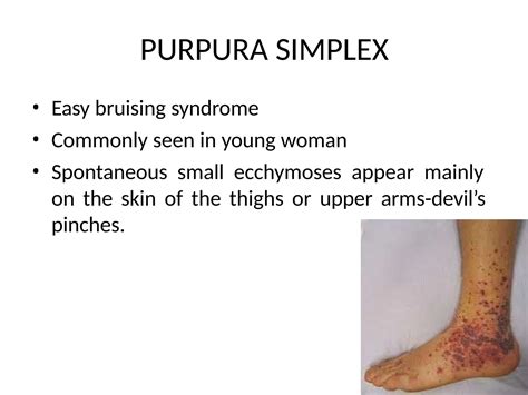 Bleeding Disorders Classification Vascular Abnormalitiespptx
