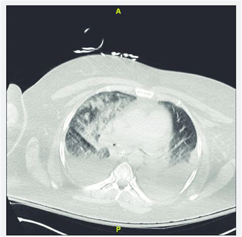 Computed Tomography Of The Chest Reveals Bilateral Pleural Effusions