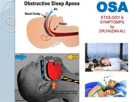 Etiology Of Obstructive Sleep Apnea