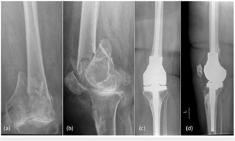 A 73 Year Old Lady With A Distal Femur Comminuted Fracture Treated With