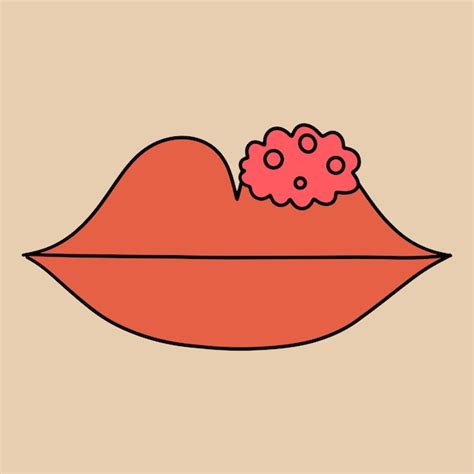 Vírus Do Herpes No Lábio Superior Ilustração Vetorial Em Estilo Simples