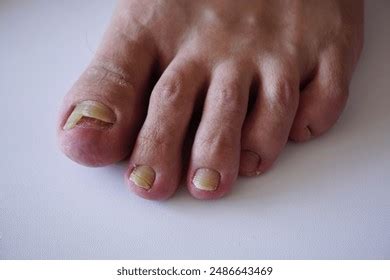 Fungal Infection Toenails Photos Images Pictures Shutterstock