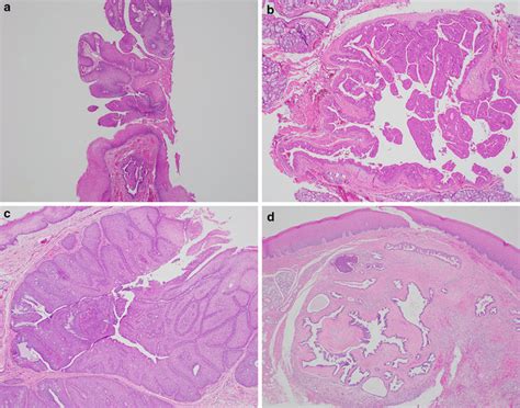 Low Power Photomicrographs Illustrating The Lesions In The Microscopic