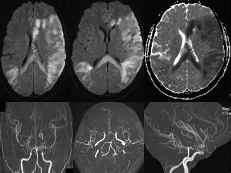 Diffusion Weighted Imaging Shows Acute Infarcts In Left Frontoparietal Download Scientific
