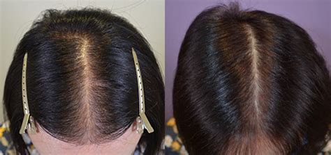 Female Hairline Recession Restored Hair Restoration Of The South