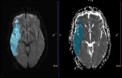 Segmentation Of The Final Infarct Volume Fiv Of The Same Patient As Download Scientific