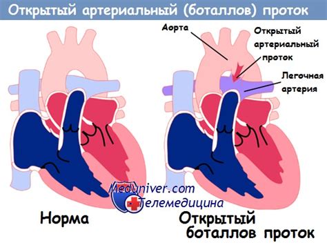 Открытый боталлов проток Диагностика открытого боталлова протока