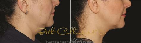 Coolsculpting® Before And After Photo Gallery Guilford Ct Results