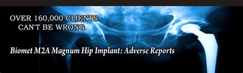 Biomet M2a Magnum Adverse Reports Biomet Hip Implant Attorneys