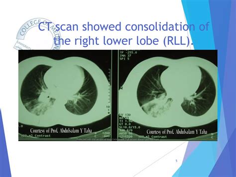 Suspected Right Lower Lobe Bronchiectasis Pdf