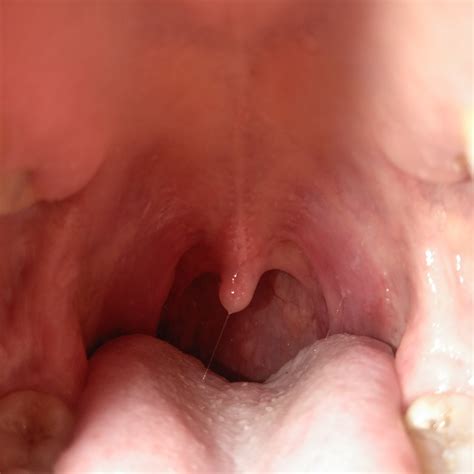 Got Some Great Pics Of My Uvula Earlier ️ Scrolller