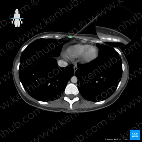 Xiphoid Process Processus Xiphoideus Kenhub Xiphoid Process Processus Xiphoideus Kenhub