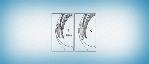 Pilonidal Sinus دکتر تولیت Dr Towliat